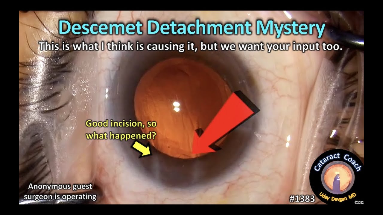 CataractCoach 1383: Descemet detachment mystery - YouTube