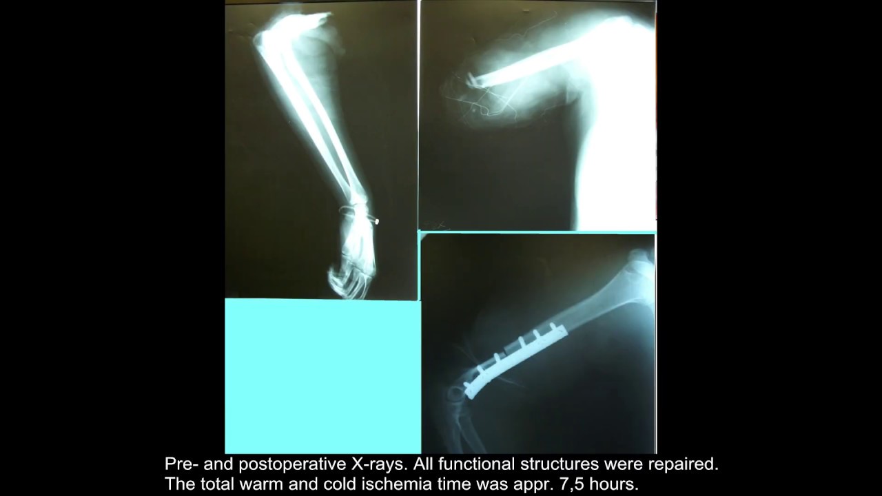 Reattachment of hand & arm. Follow-up result 9-years after amputation ...