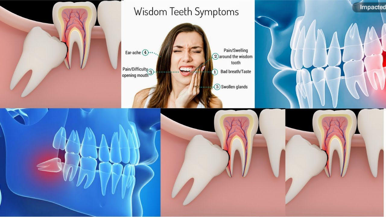What are wisdom teeth(wisdom teeth removal surgery) Animation video ...