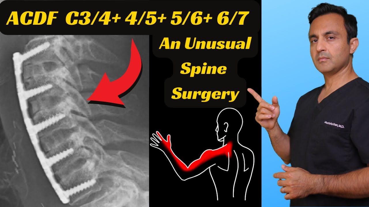 FOUR-level ACDF surgery: How it's done - YouTube