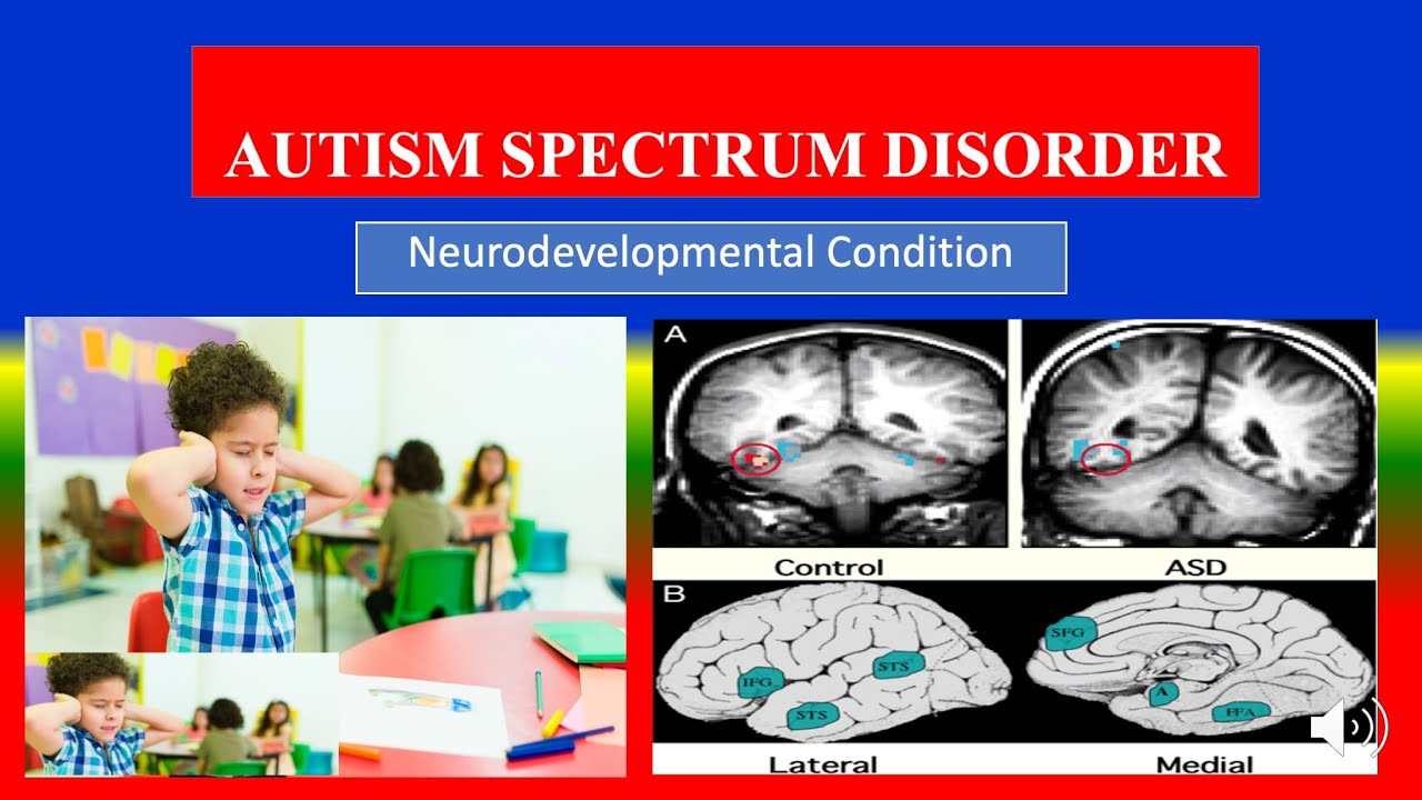 AUTISM SPECTRUM DISORDER - Define , types, causes, pathophysiology ...