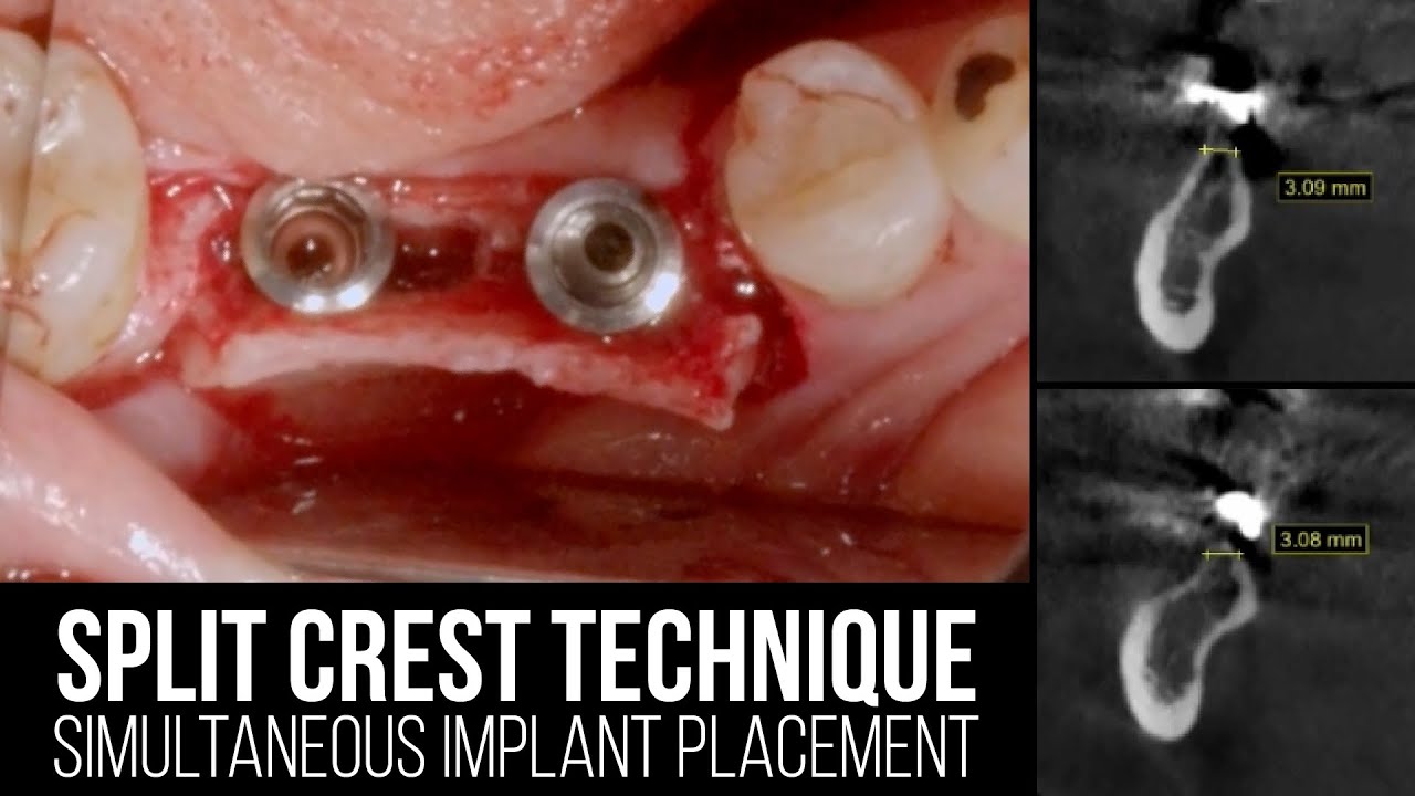 Split Crest Technique (with simultaneous implant placement) - YouTube