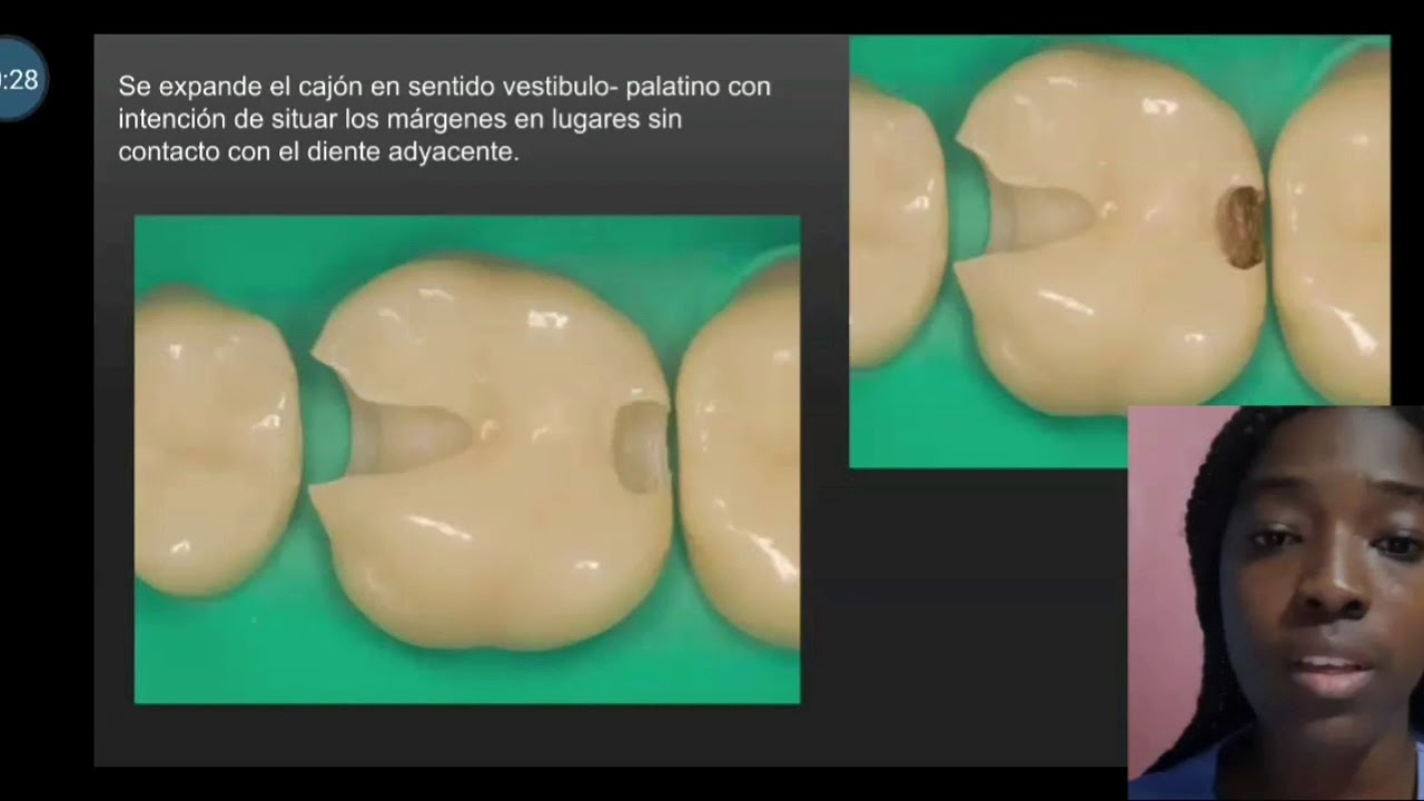 Preparación y restauración de clase II con amalgama - YouTube