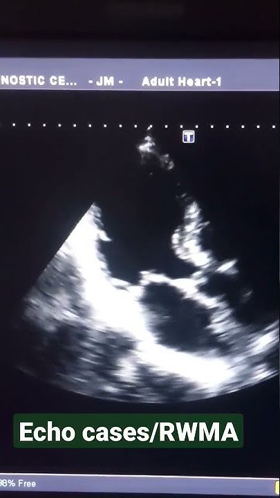 echo cases/RWMA - YouTube