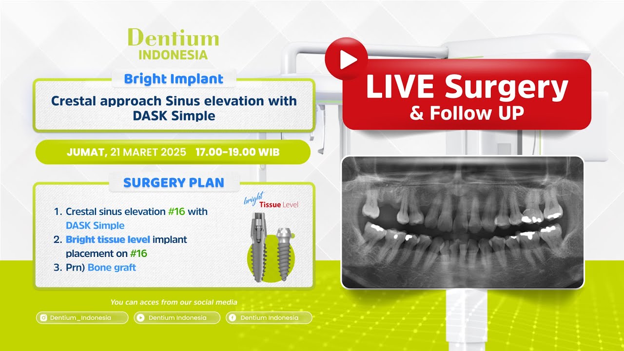 Live Surgery "Crestal approach Sinus elevation with DASK Simple - YouTube