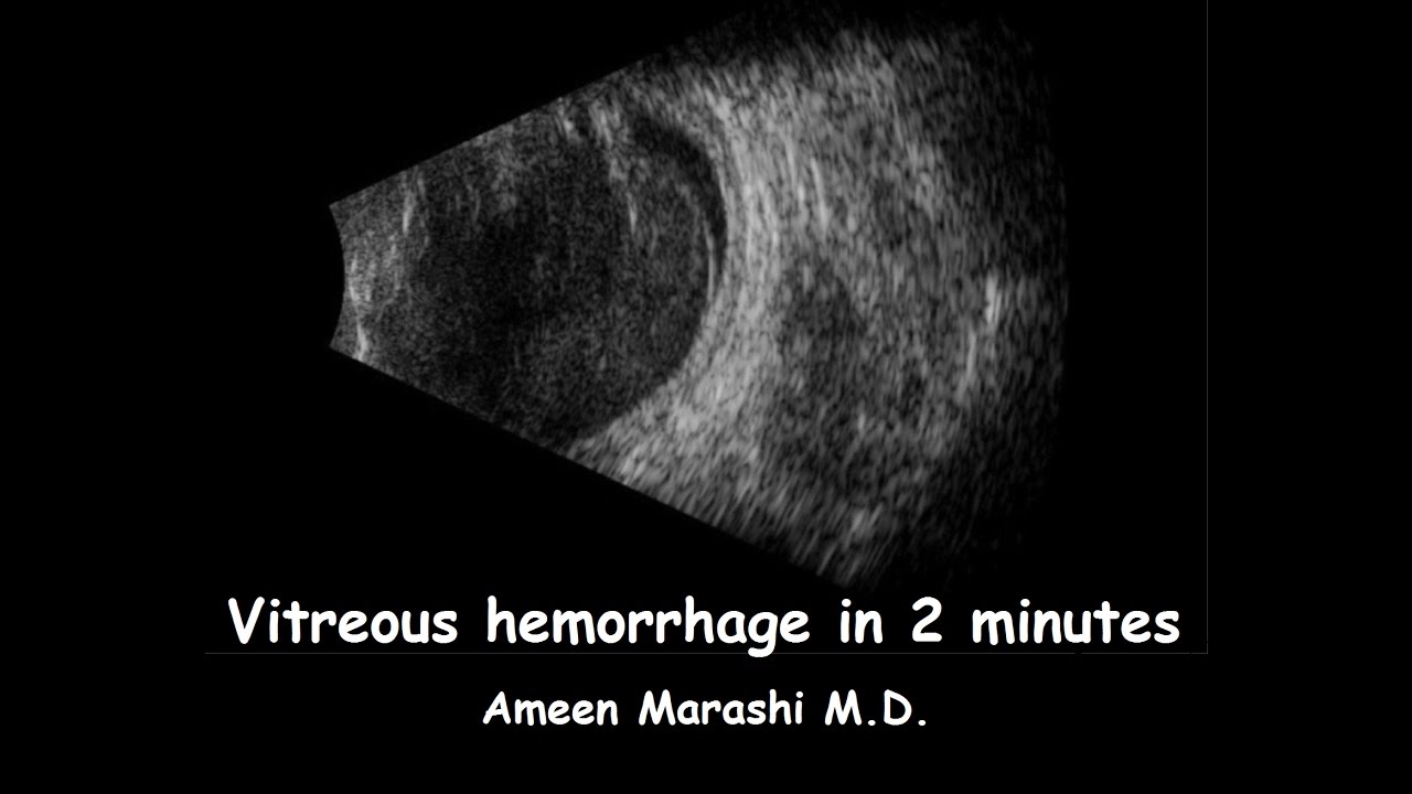 Vitreous hemorrhage in 2 minutes - YouTube