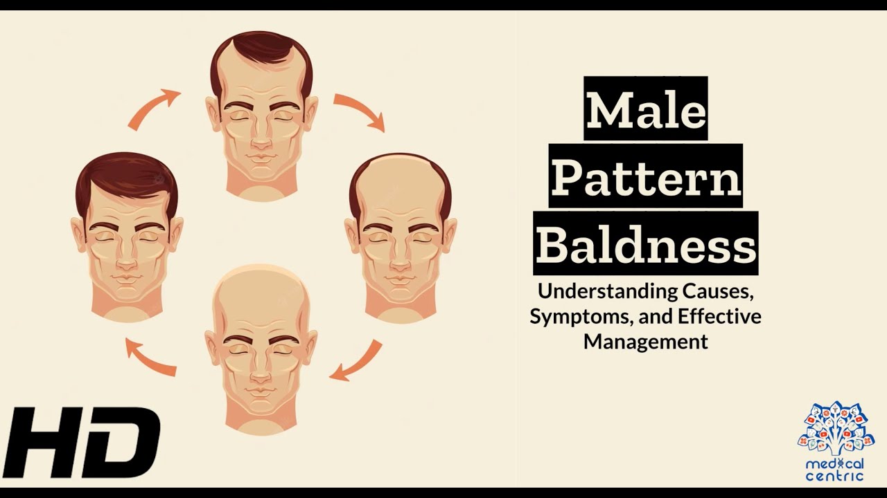 Male Pattern Baldness Explained Everything You Need To Know Youtube