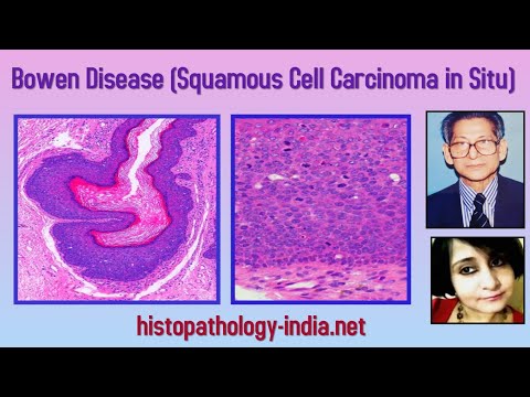 Pathology of Bowen Disease /Squamous Cell Carcinoma in Situ - Dr ...
