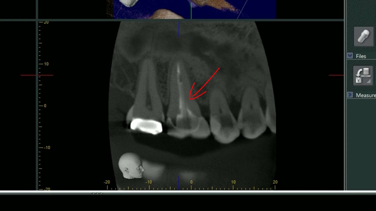 Fiber Post Removal combining Microscope and Finder US Tip from Helse ...
