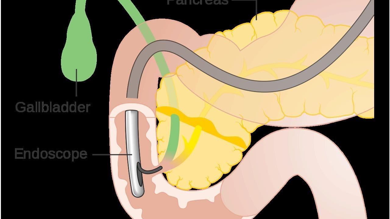 Endoskopowa cholangiopakreatografia wsteczna (ECPW) - YouTube