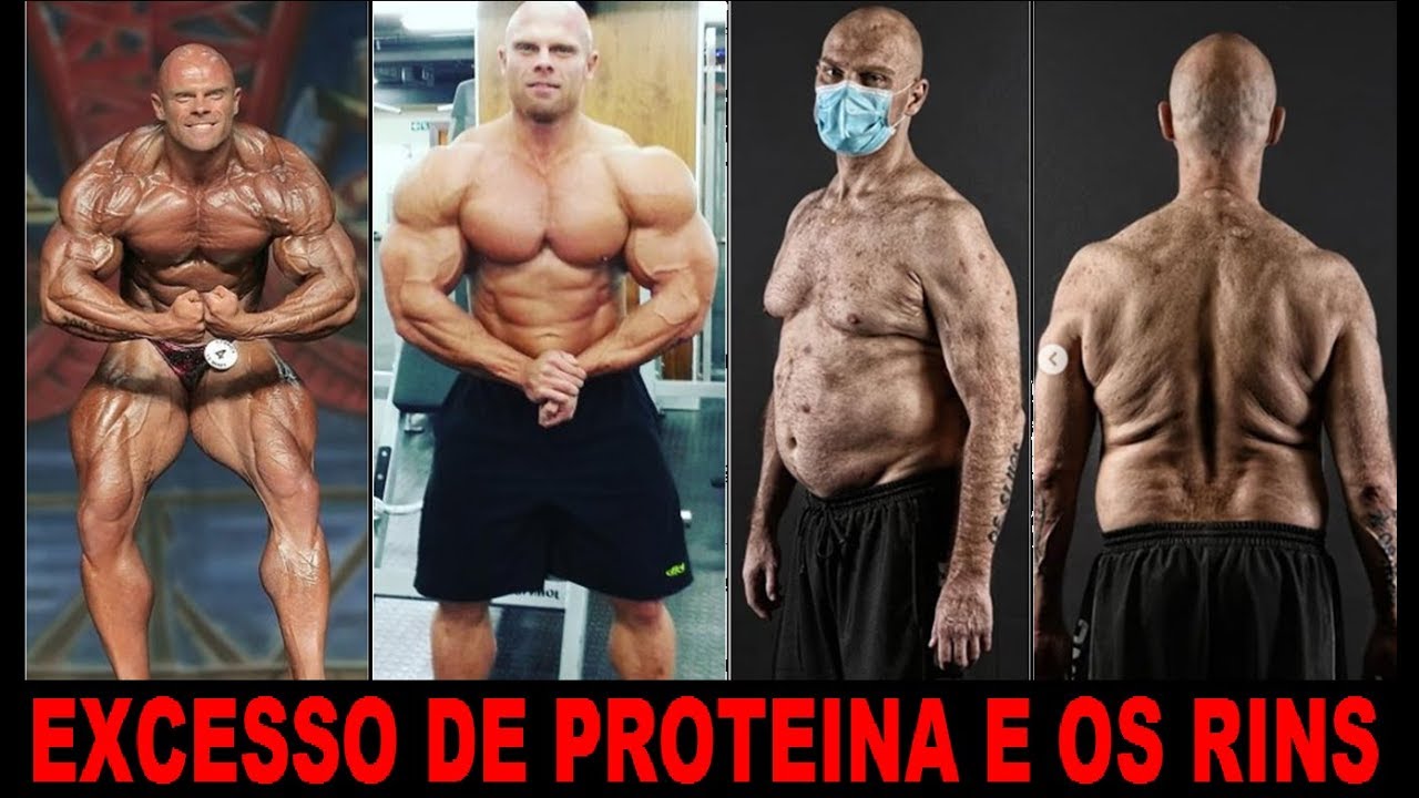 PROBLEMAS RENAIS NO BODYBUILDING | UM POUCO DA HISTORIA DE MARIUS DOHNE ...