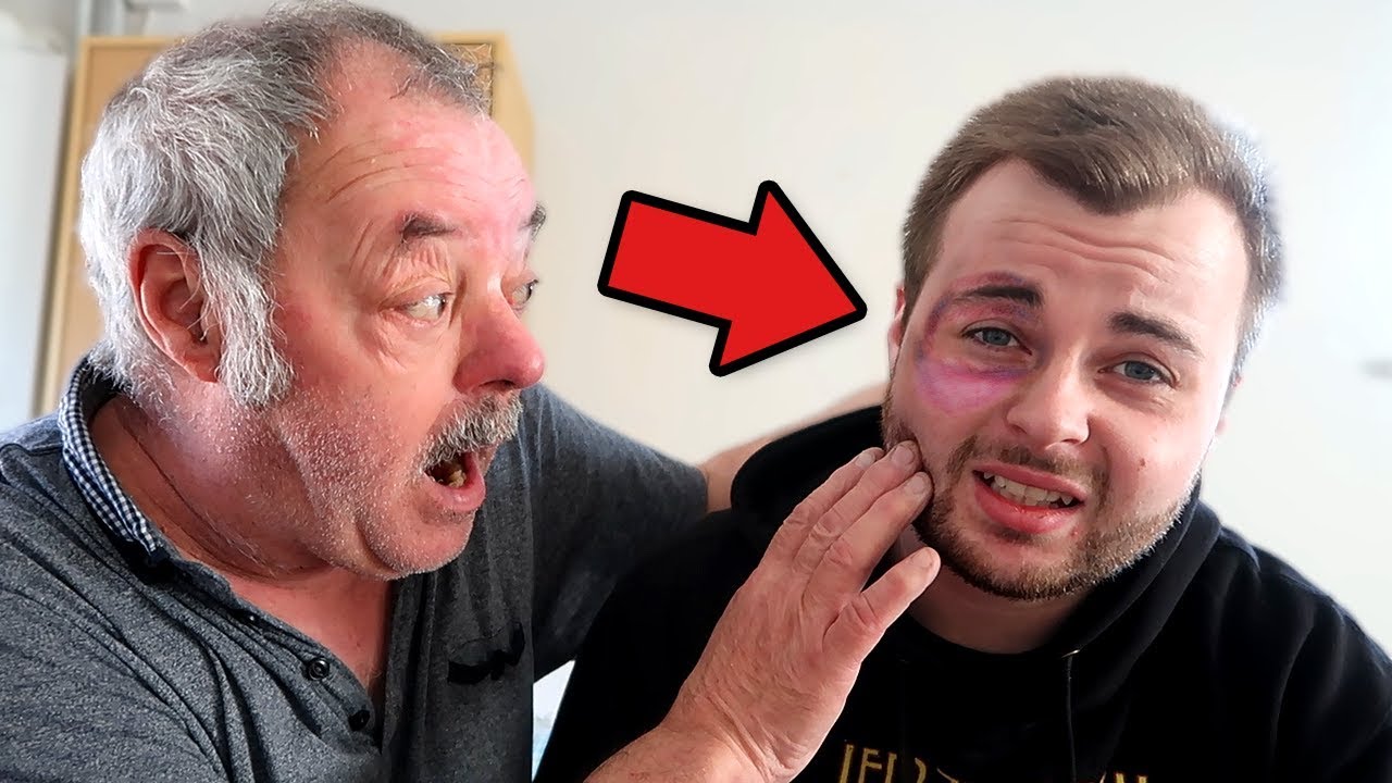 BLACK EYE PRANK ON MY DAD - YouTube