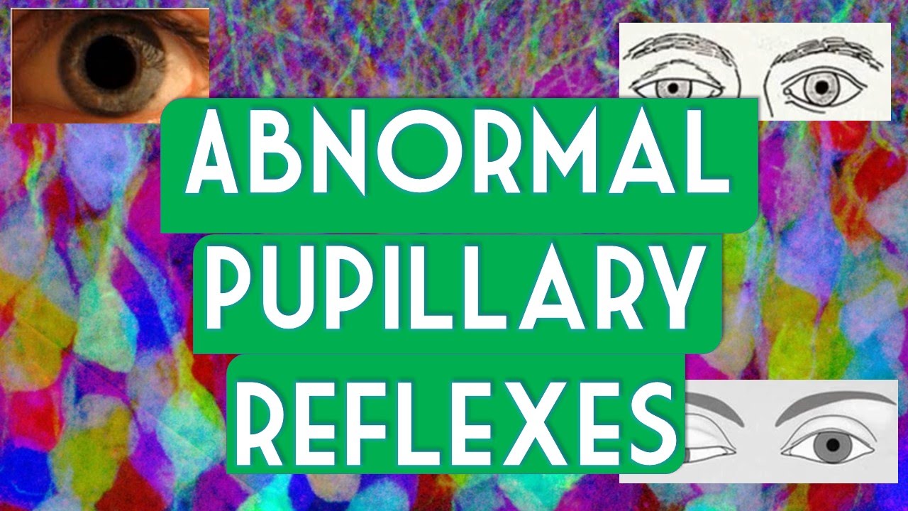 Abnormal pupillary reflexes - YouTube