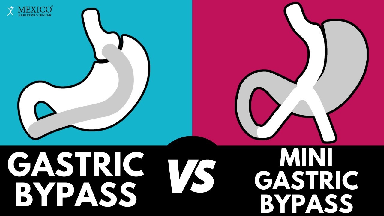 Gastric Bypass VS Mini Gastric Bypass - YouTube