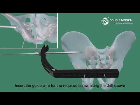 Double Medical Posterior Pelvis Fixation - YouTube