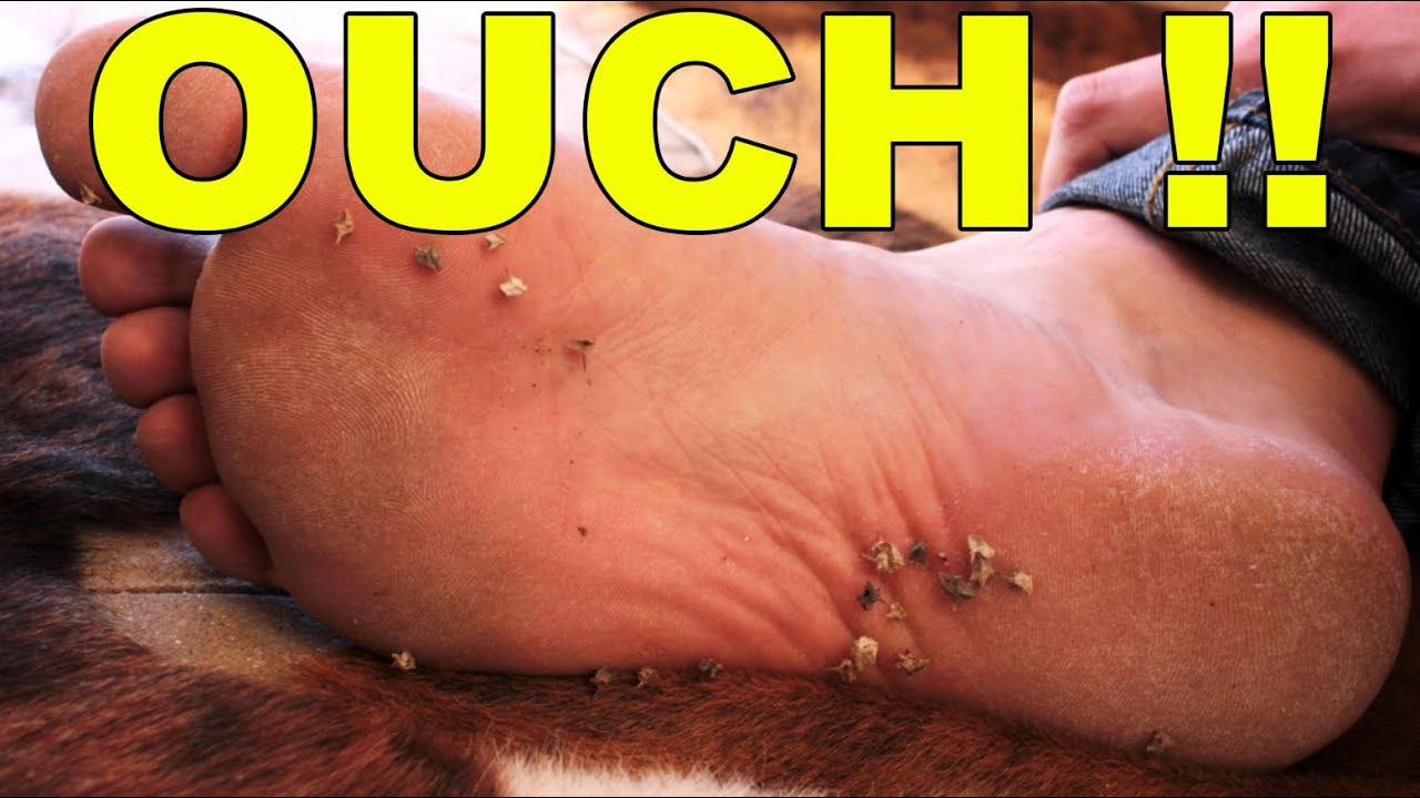 How to Get Rid of Lawn Prickles Naturally Without Chemicals - YouTube