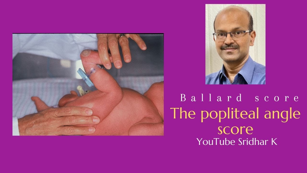 Popliteal angle as part of Ballard score. Dr Sridhar K - YouTube
