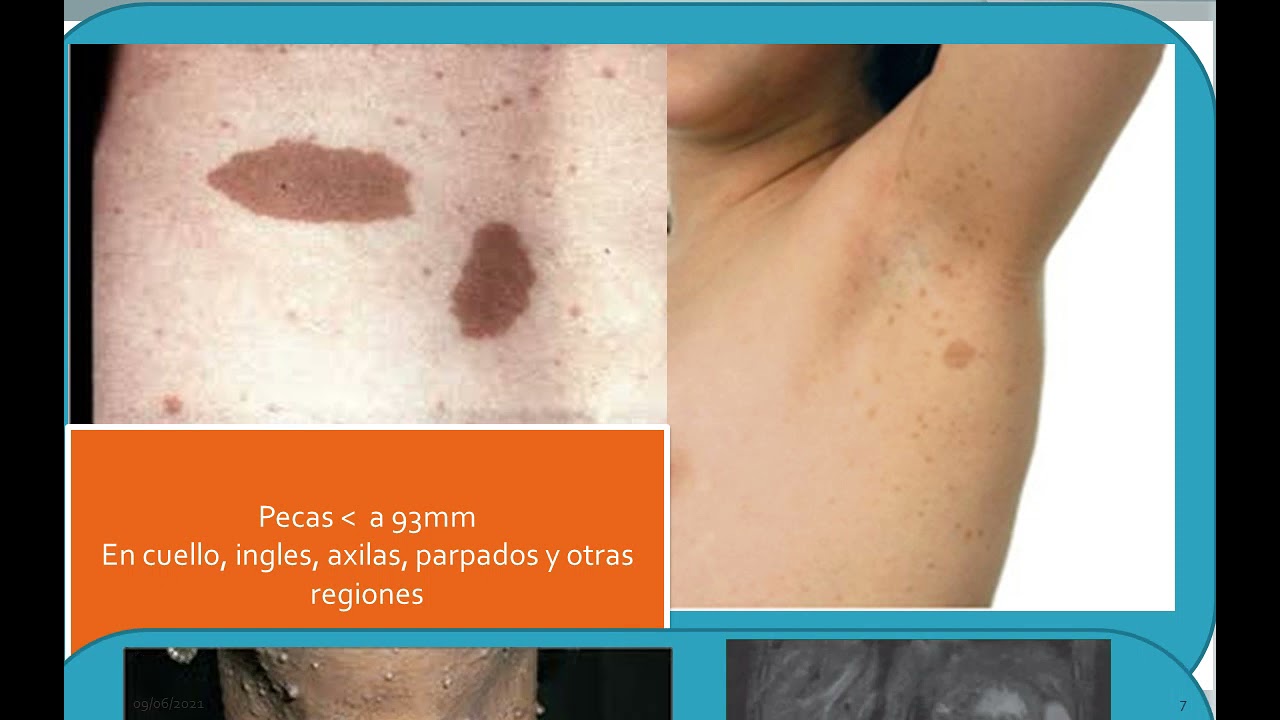 Neurofibromatosis tipo 1 FESI - YouTube