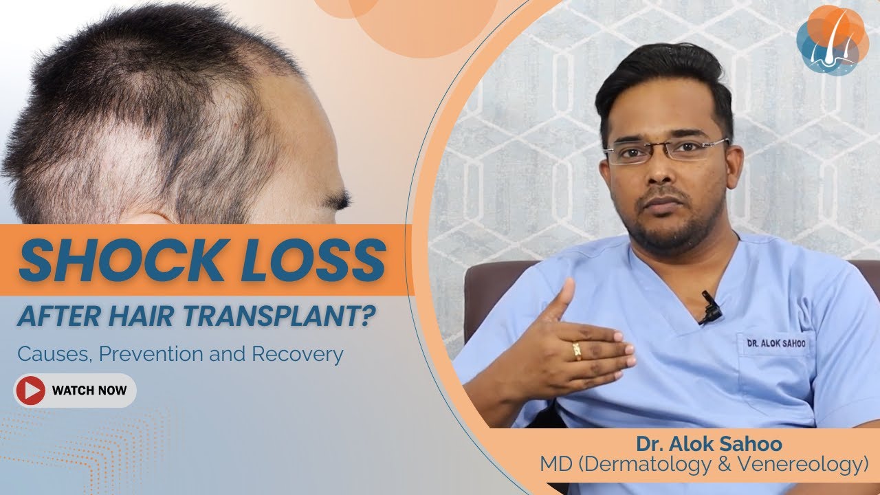 Shock loss after a hair transplant? | Know the causes, prevention, and ...