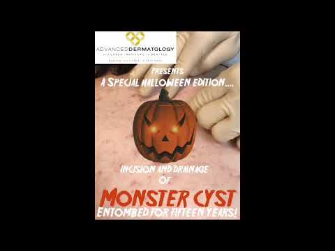 Epidermoid Cyst Extraction | Dr. Steven Greene in Seattle - YouTube