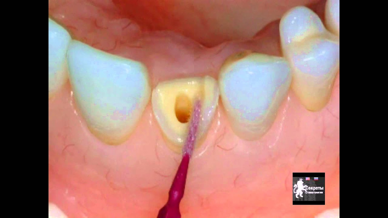 post+core composite 1 Скловолоконні штифти 1 - YouTube