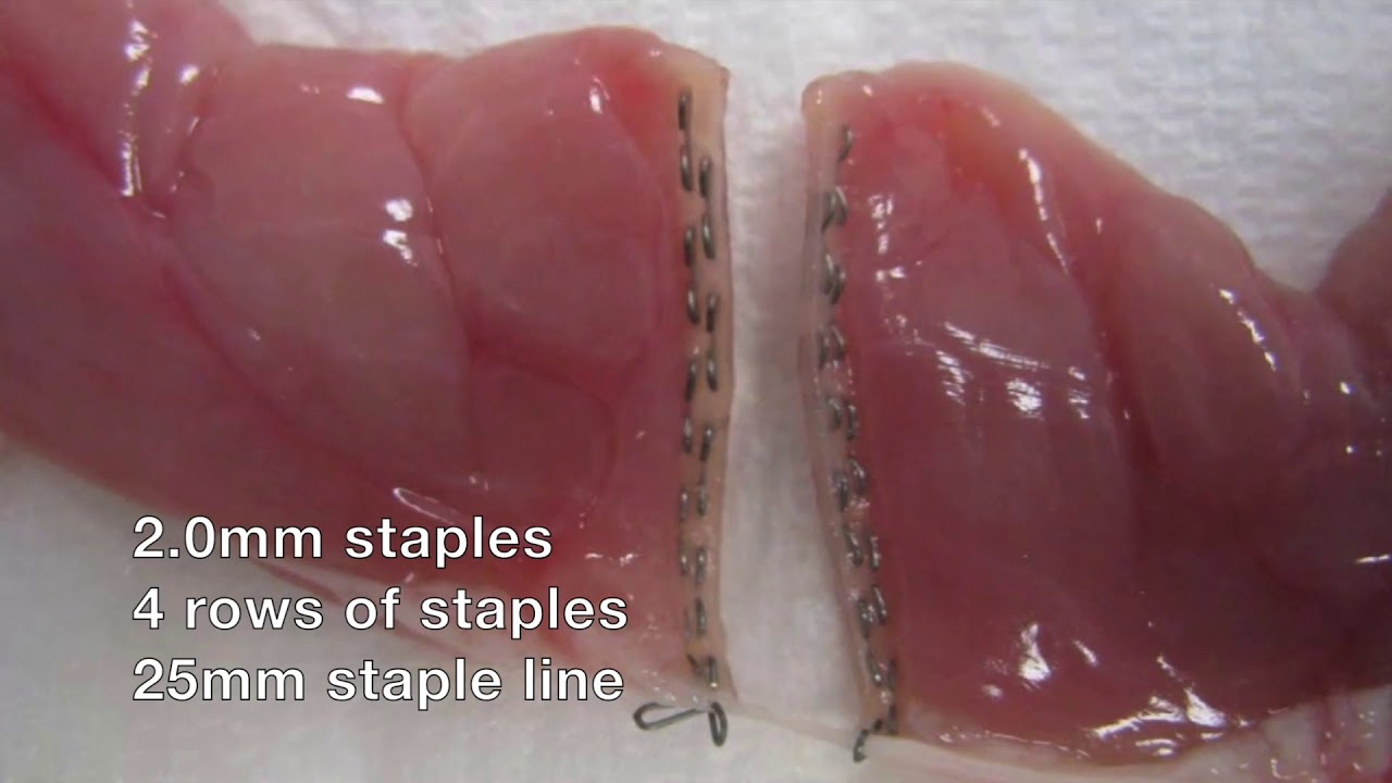 Laparoscopic Appendectomy Using The JustRight 5mm Stapler YouTube Laparoscopic Appendectomy Using The JustRight 5mm Stapler YouTube