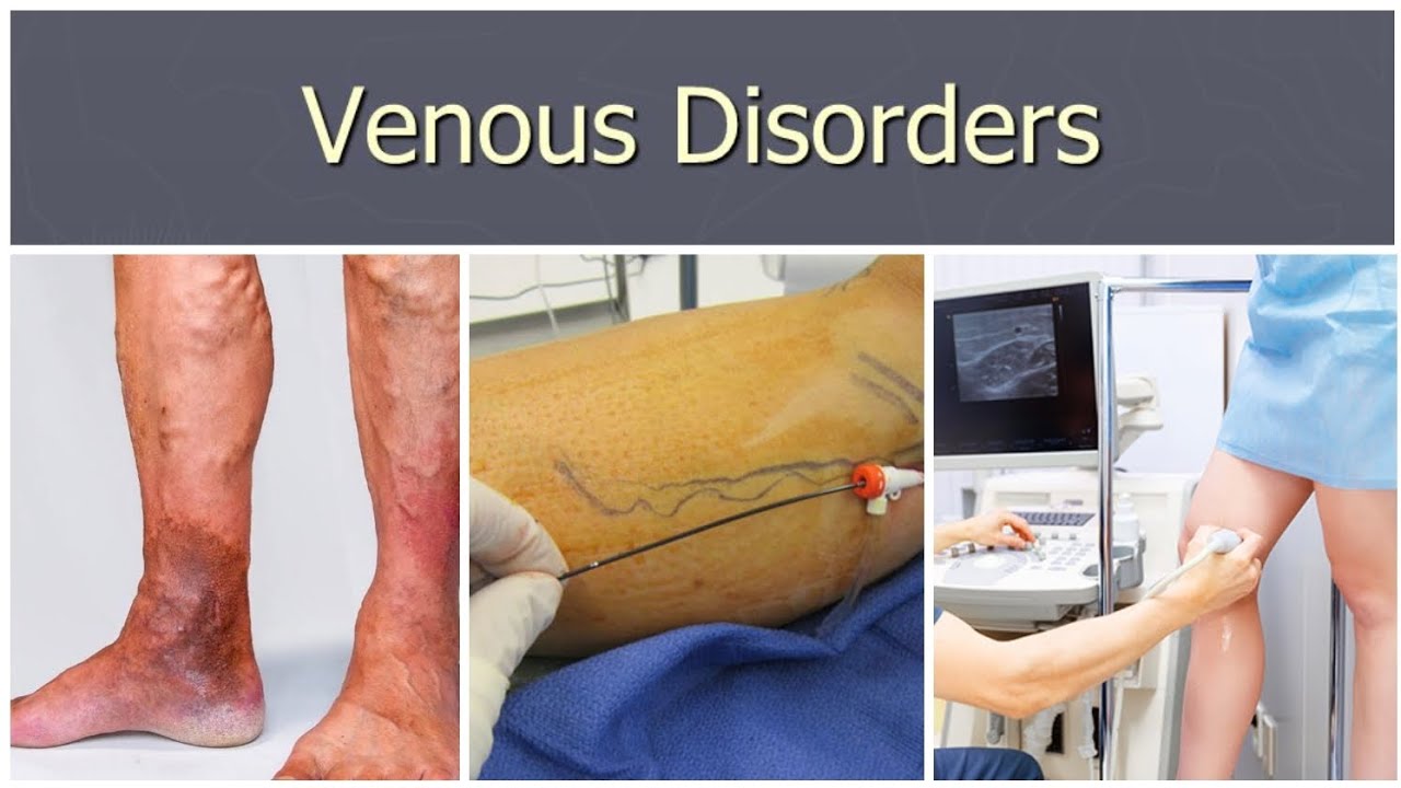 Venous Disorders 3 | Saphena Varix, Deep Venous Thrombosis - YouTube
