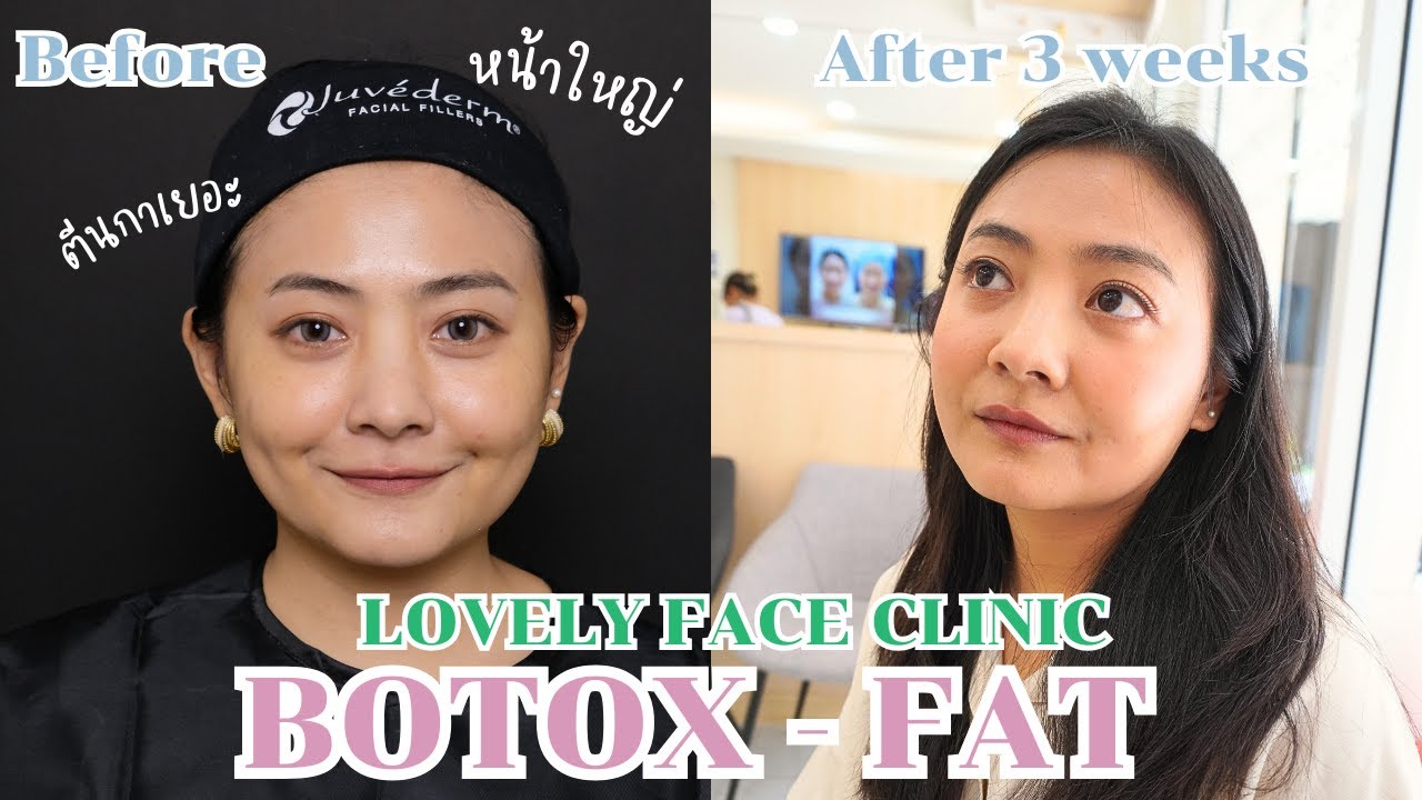 เจอแล้วว!! คลินิกหัตถการ Botox และ Fat ทีจะให้ดูแลหน้าเราตลอดไปปป ...