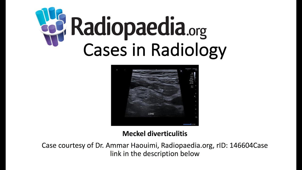 Meckel diverticulitis (Radiopaedia.org) Cases in Radiology - YouTube