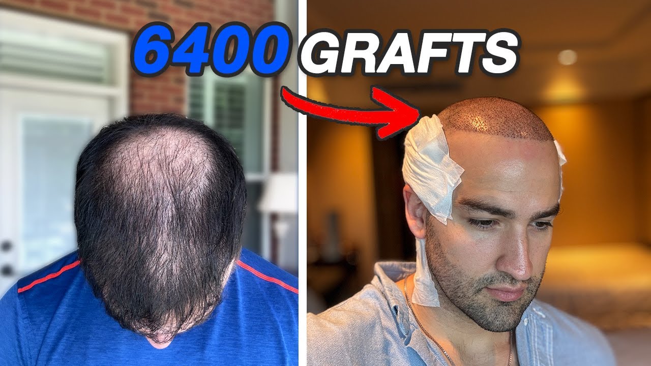 My 2nd Hair Transplant in Turkey | Now Hair Time Clinic | FULL ...