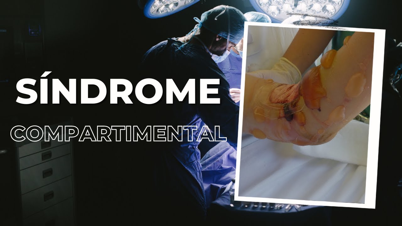 Síndrome compartimental - Prevención, diagnóstico y manejo - YouTube