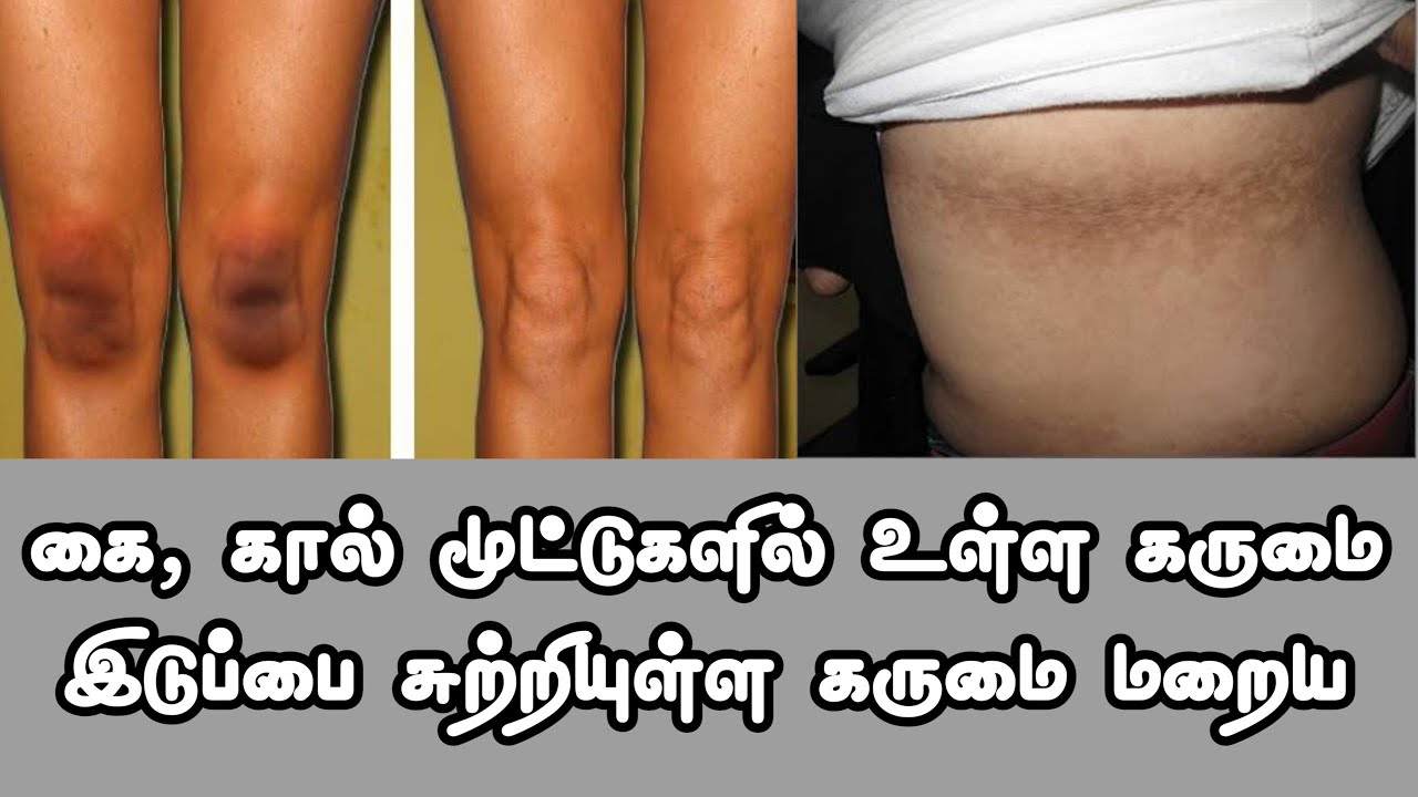 Remove black on knee and elbows / Remove black marks around hip - YouTube