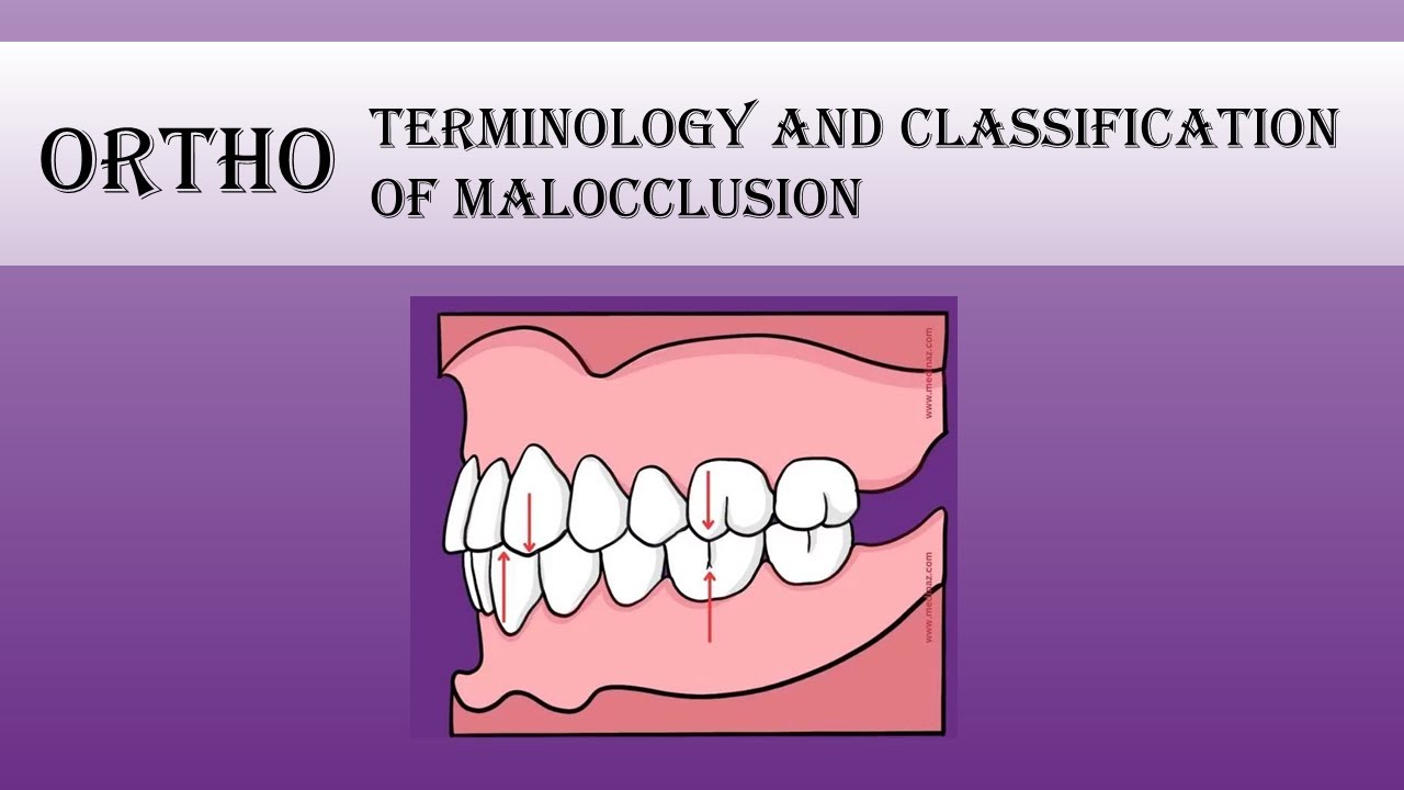 Ortho - Terminology and classification of malocclusion Part 2 - YouTube
