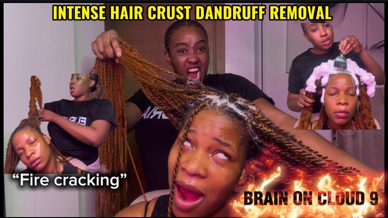 ASMR:Ultimate flakes removal,Soft whispers Scalp scratching ...