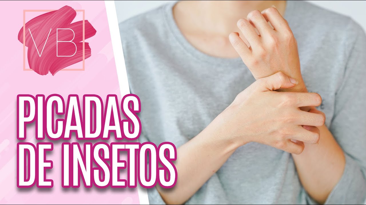 Picadas de Inseto: saiba como prevenir reações alérgicas - Você Bonita ...
