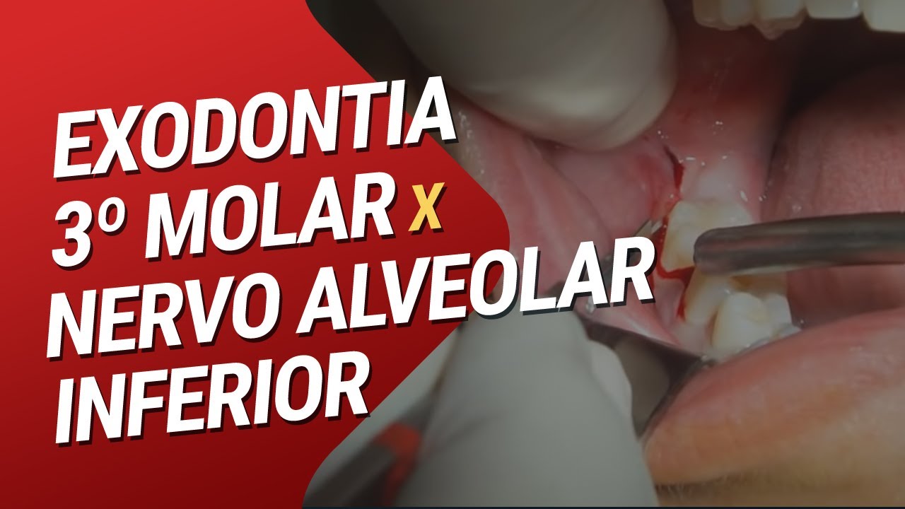 📍Exodontia de terceiro molar em contato íntimo ao nervo alveolar ...
