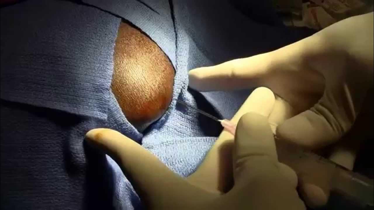 Needle Aspiration of Olecranon Bursitis - YouTube