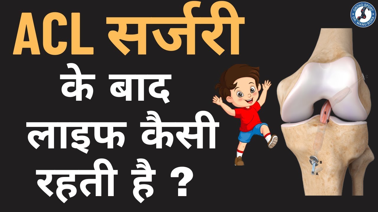 ACL सर्जरी के बाद लाइफ कैसी रहती है ? How is life after ACL surgery ...