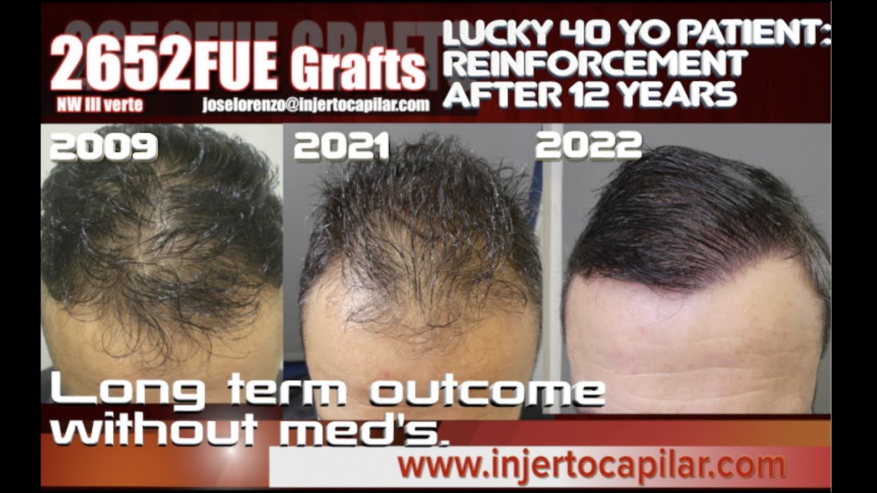 2652FUE Grafts. DPA III V. 12 years long term in a lucky 40 yo patient ...