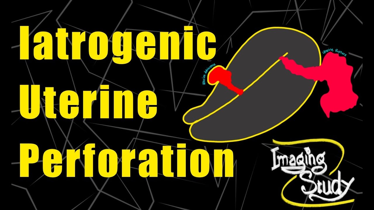 Iatrogenic Uterine Perforation || Ultrasound || Case 200 - YouTube