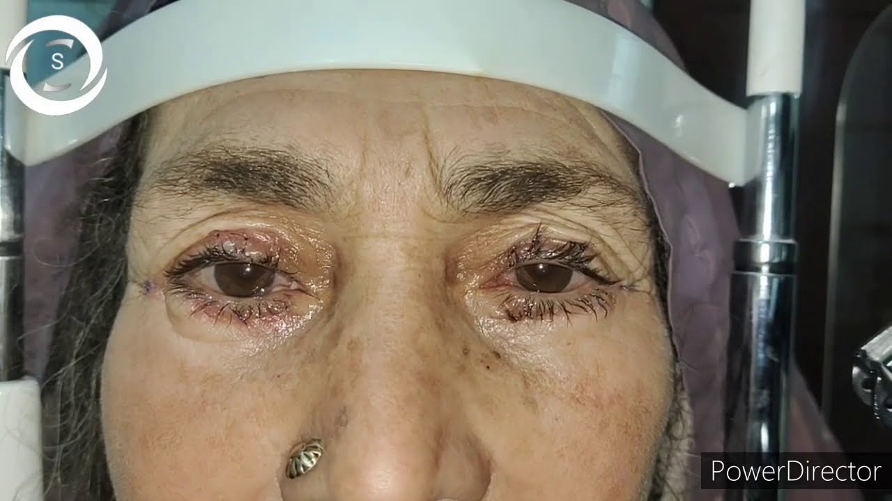 Post Orbicularis myectomy CC23 - YouTube