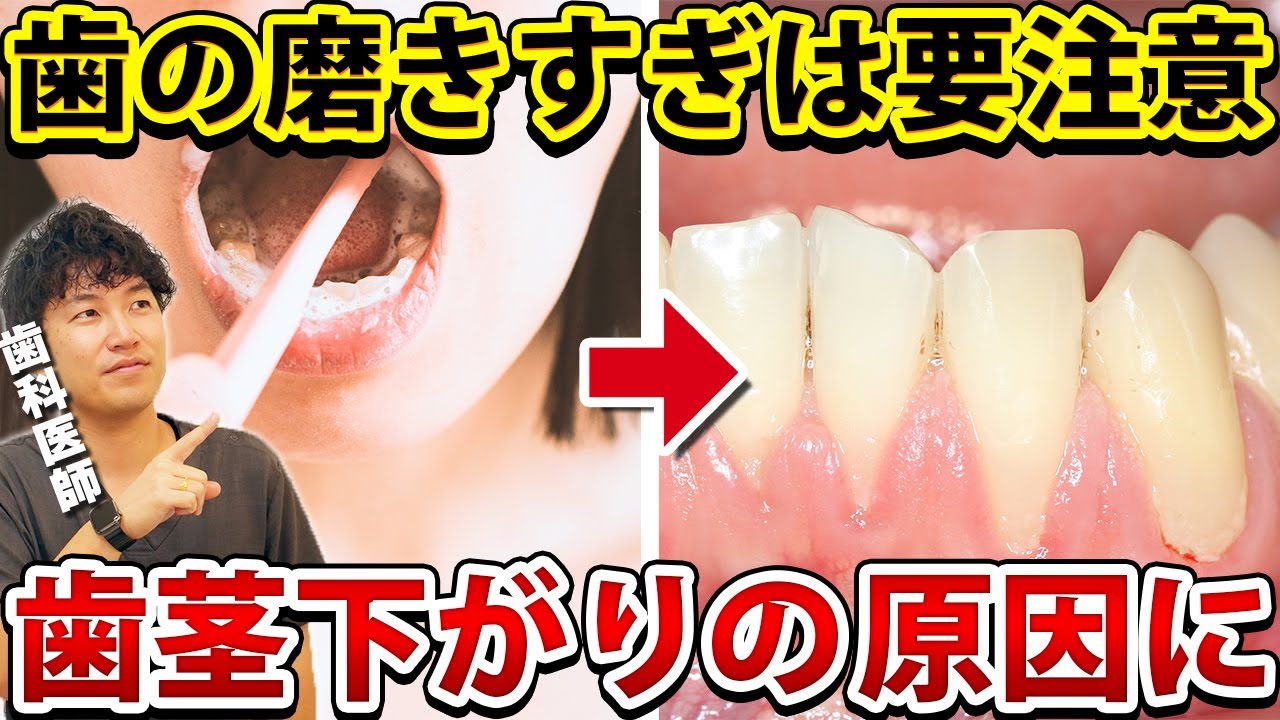 【歯茎下がり】歯の磨きすぎで歯茎が下がる?対処法を歯医者が解説! Youtube