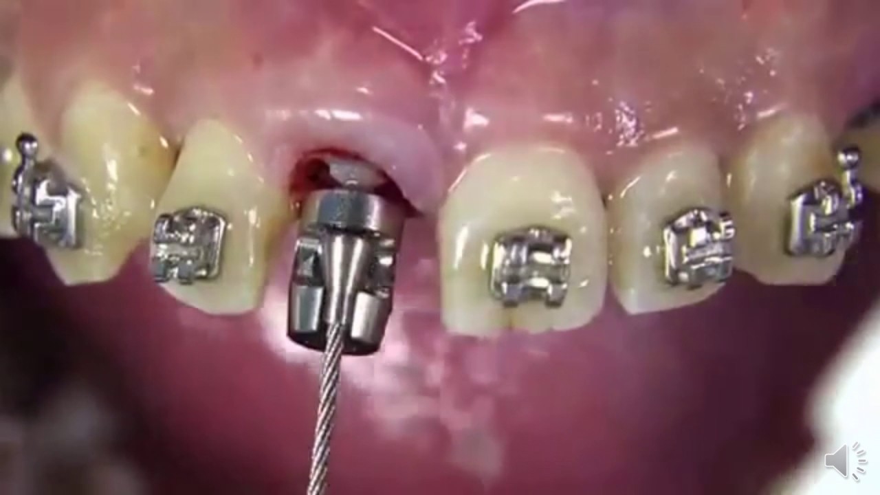 benex tooth extraction system - YouTube
