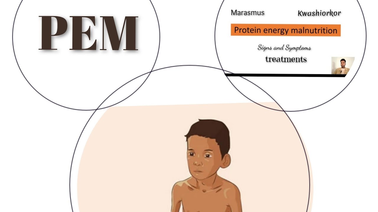 Protein Energy Malnutrition (PEM): Marasmus, Kwashiorkor, Mixed: Causes ...