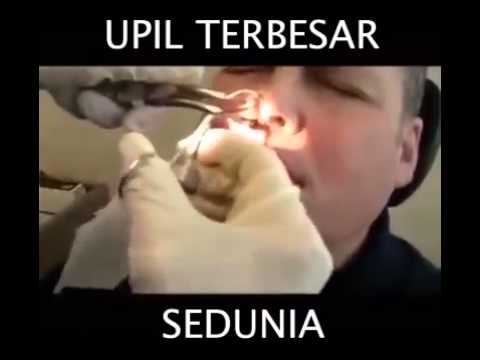 upil terbesar di dunia - YouTube