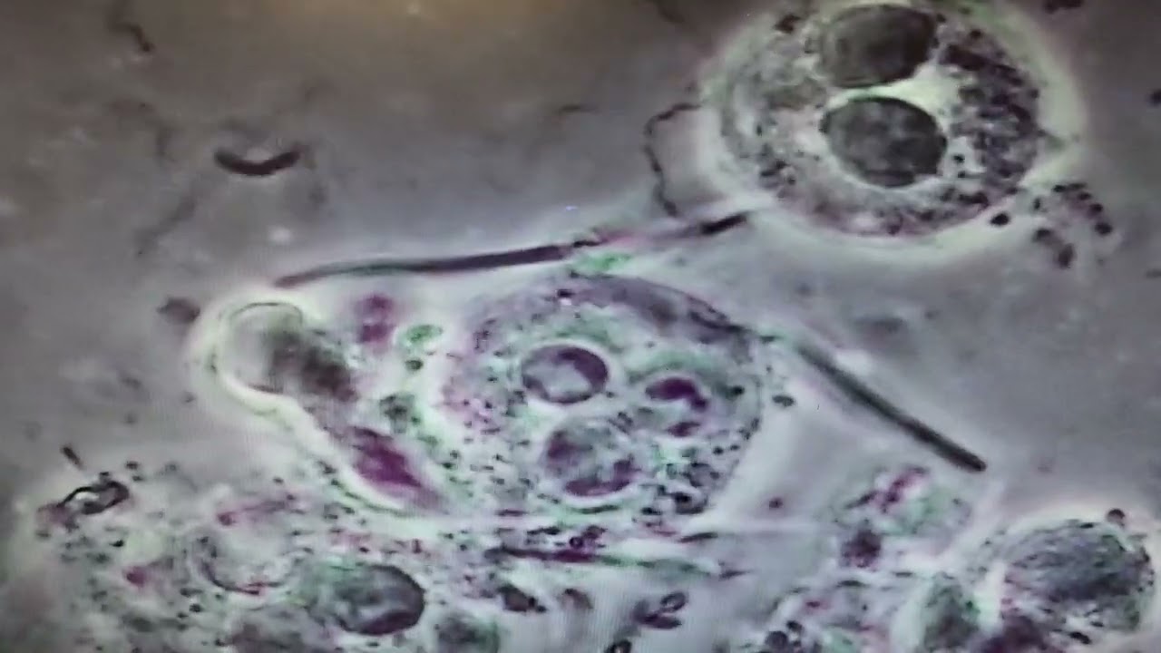 White blood cells fighting Amoeba. - YouTube