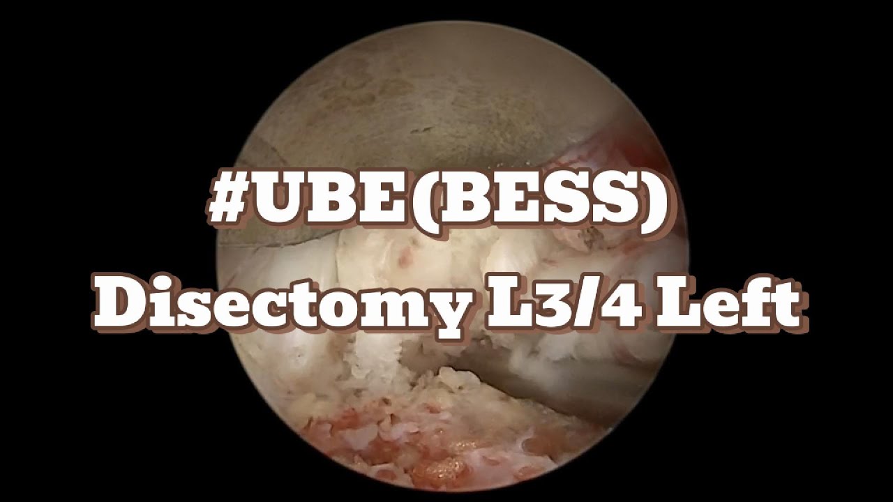 UBE(BESS) Disectomy L3/4 Lt - YouTube