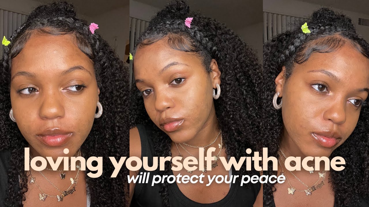 How to Love Yourself with Acne: my tips that protect my peace - YouTube