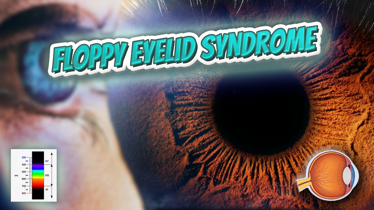 Floppy eyelid syndrome (Your EYEBALLS) 👁️👁️💉😳💊🔊💯 - YouTube
