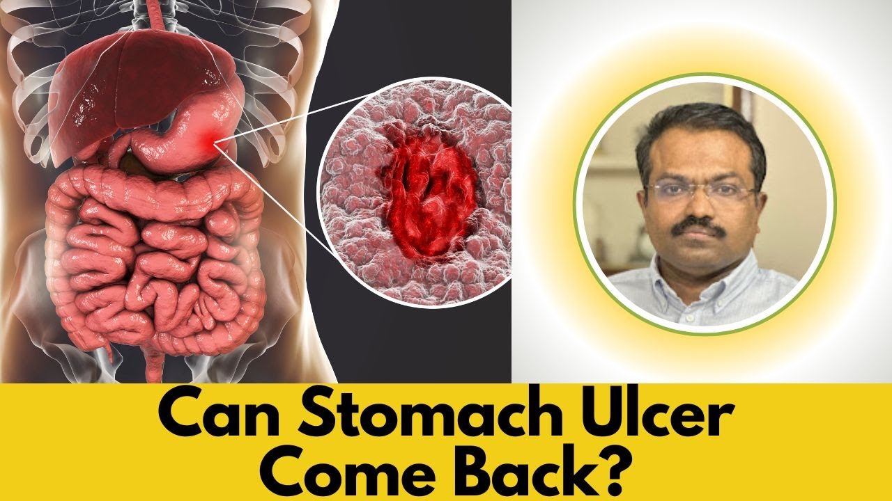 Can Stomach Ulcer Come Back? | Gastric Ulcer Recurrence by Dr Maran ...